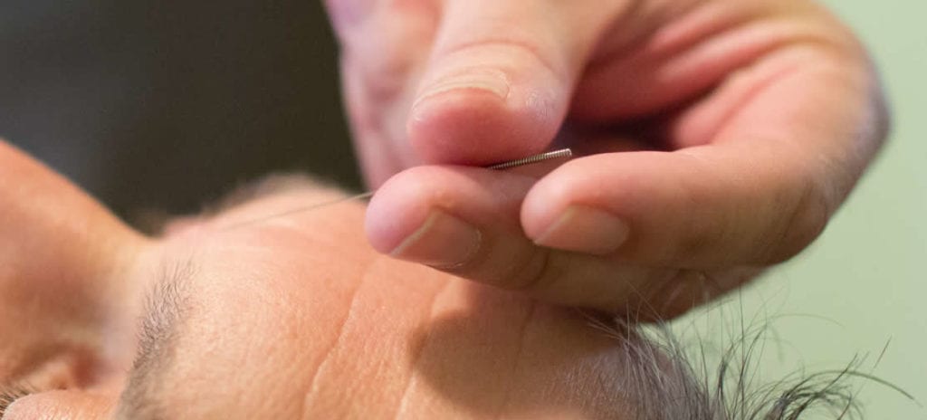 Motor Point Acupuncture is Here! - Origins Medicine